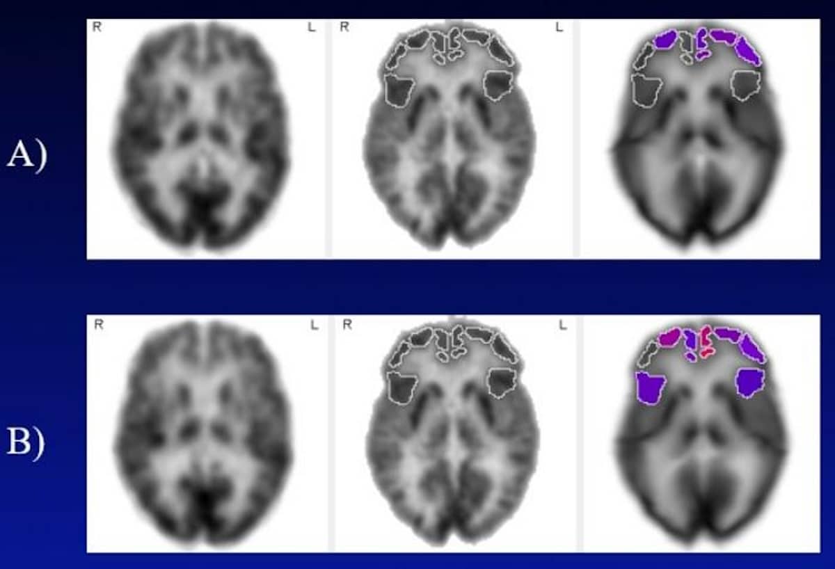 Brain scans show hearing aids help slow brain aging in mild cognitive ...