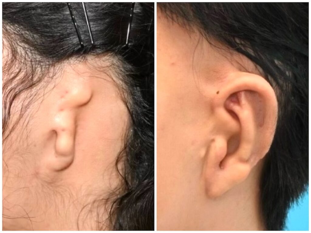 World first nerve freezing technique reduces pain after ear ...